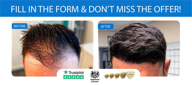 Cheap Hair Transplants In Turkey Uk